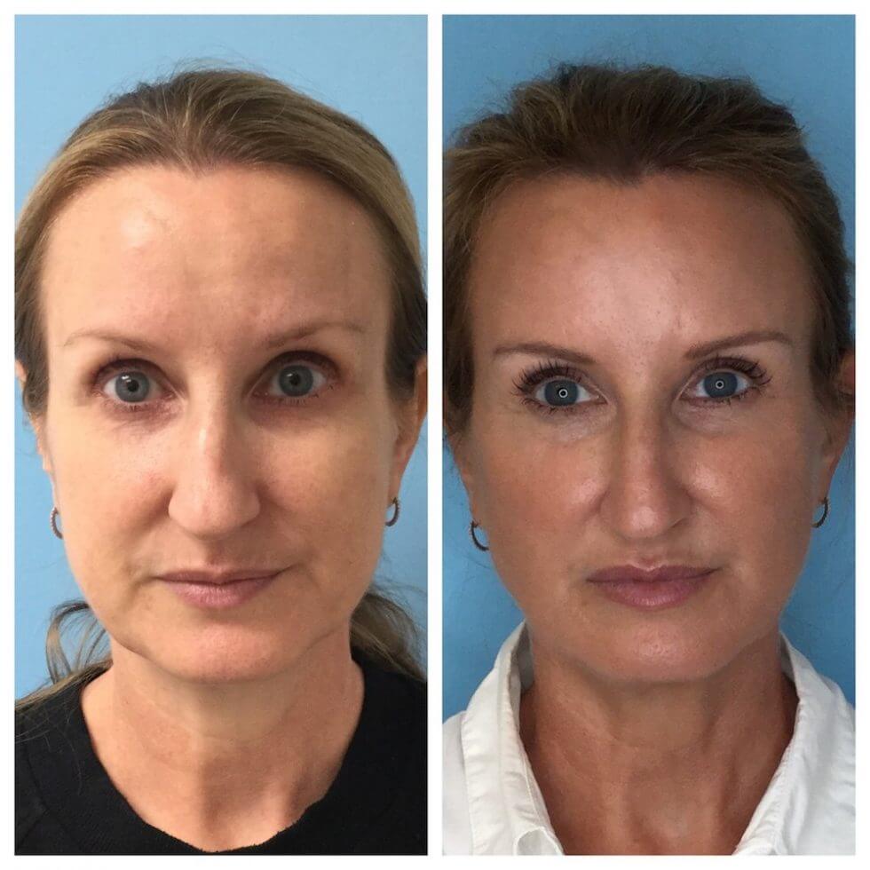 Cosmetic Thread Lifts - Glam + Glo Medical Aesthetics Lounge