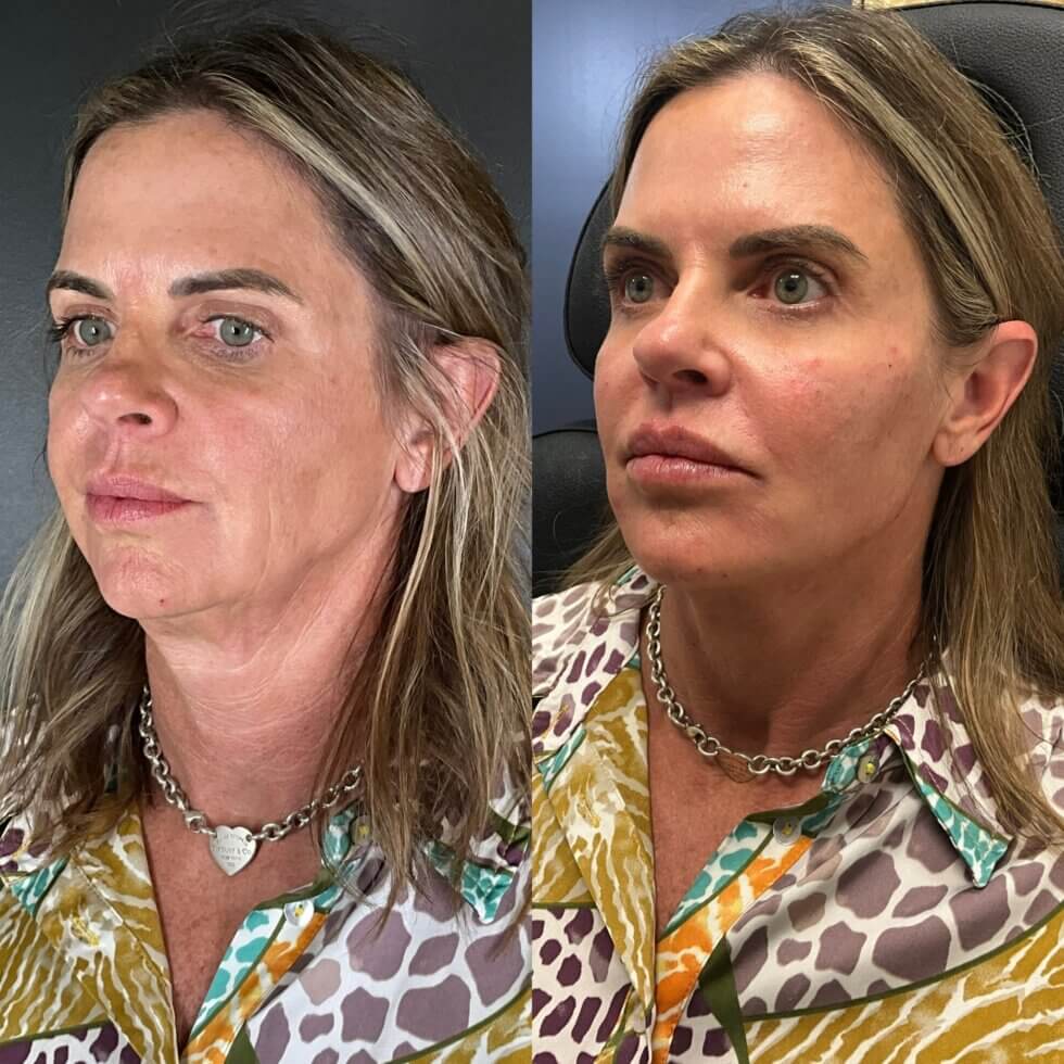 Luxury lift - Glam + Glo Medical Aesthetics Lounge